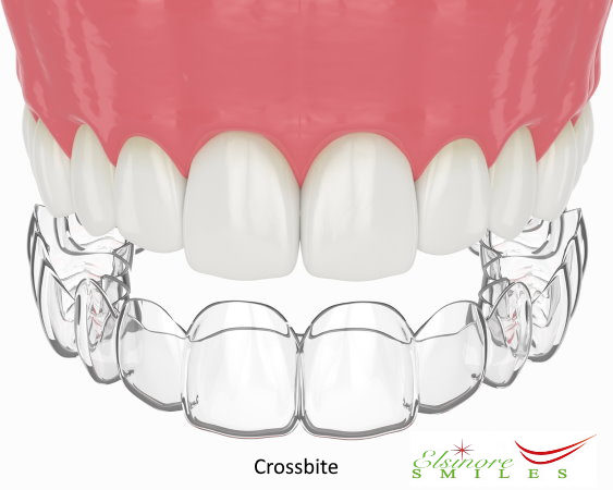Crossbite - What is a Crossbite? Causes, Treatments